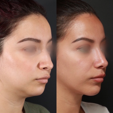 Price List Toronto | Chin & Cheek Augmentation