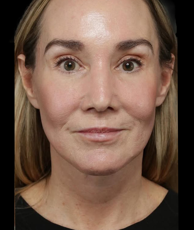 Mid Face Lift Toronto | Facelift Specialist Yorkville